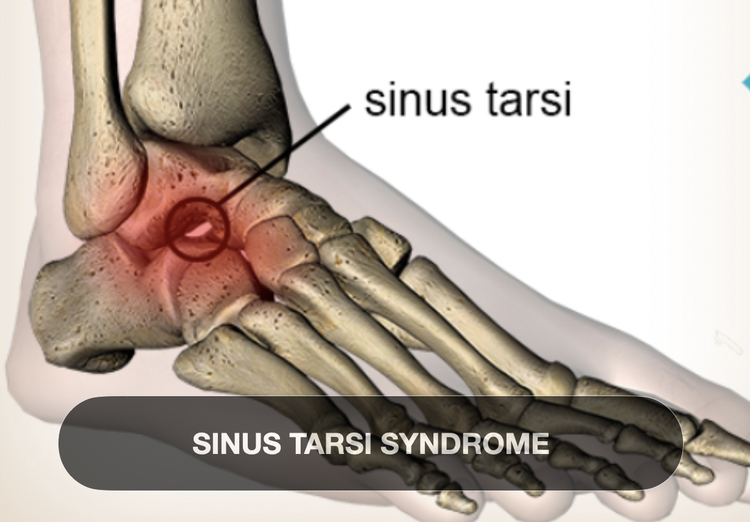 Sinus Tarsi Syndrome — Lower Extremity Group