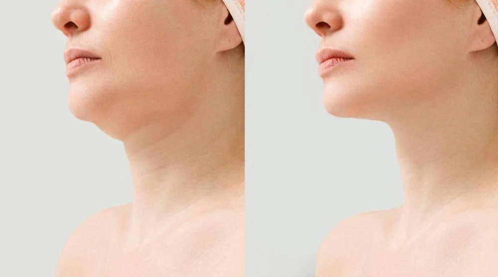 Double Chins Adelaide — The Clinique Aesthetics