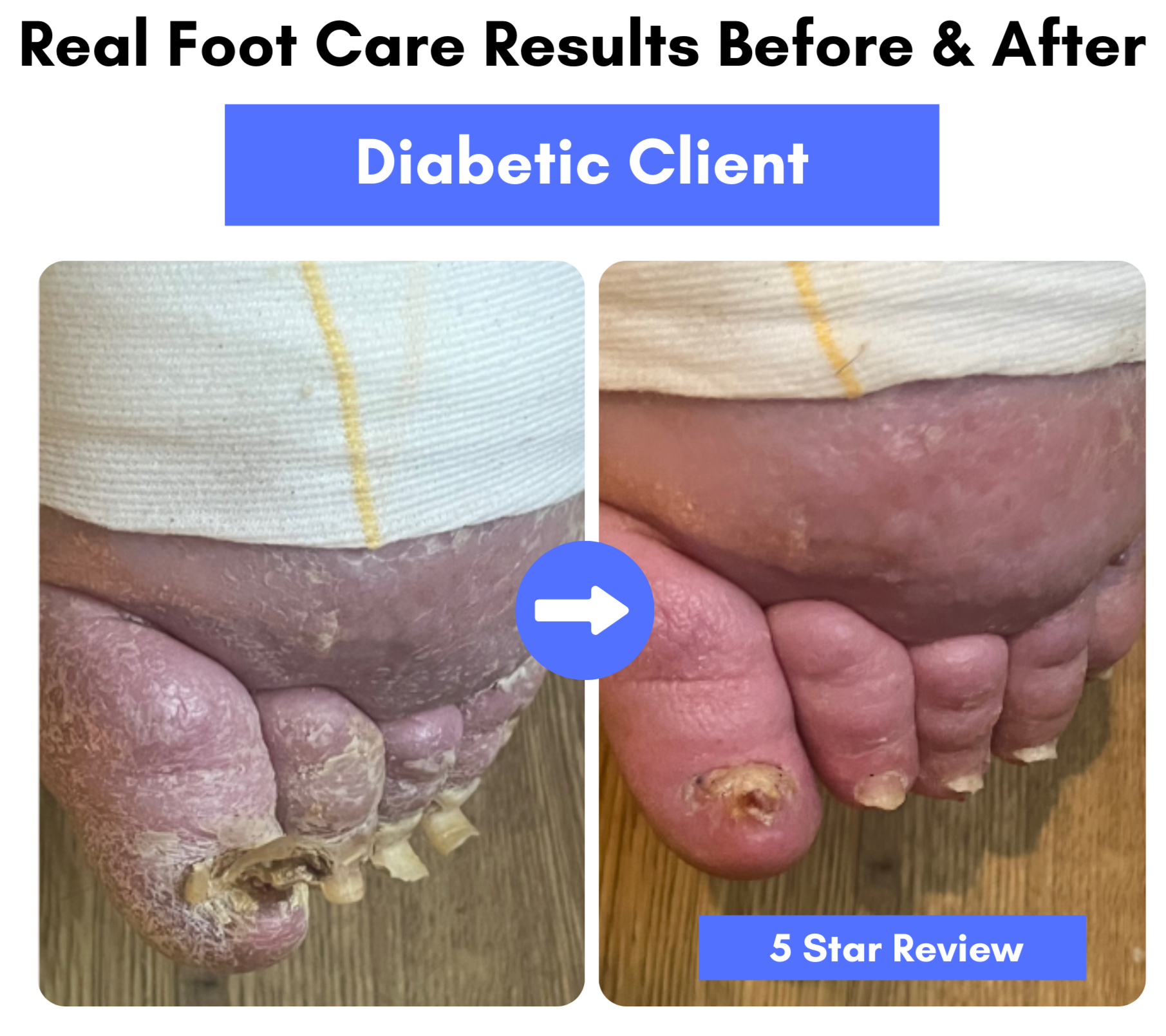Toenail Cutting Service for Elderly Near Me | Gina Foot Care — Gina ...
