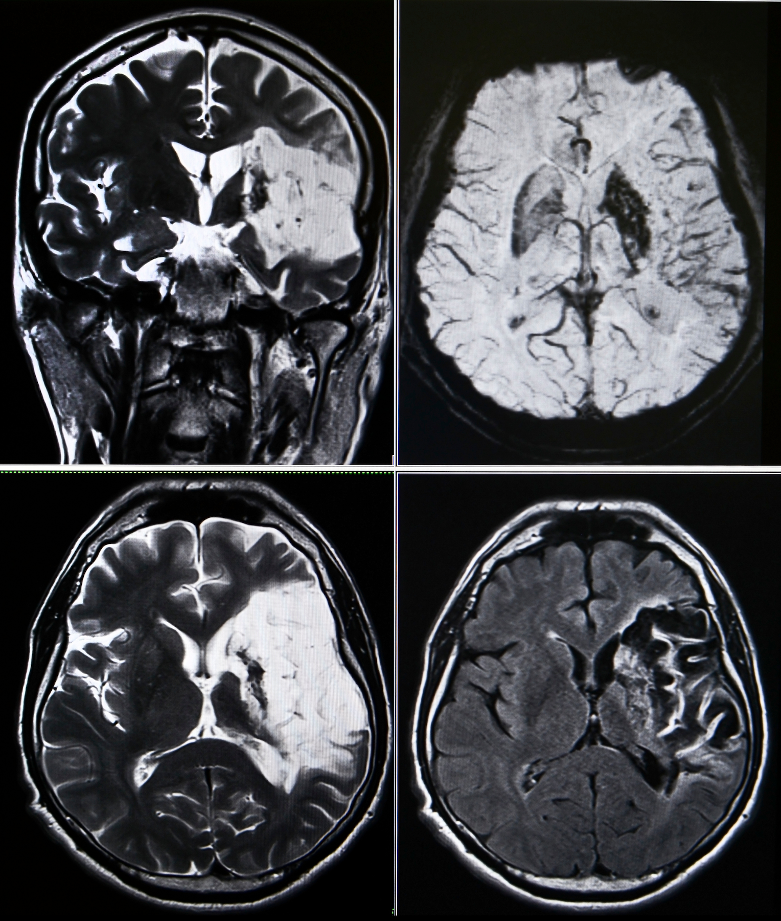 Stroke & Traumatic Brain Injury — Steps for Recovery