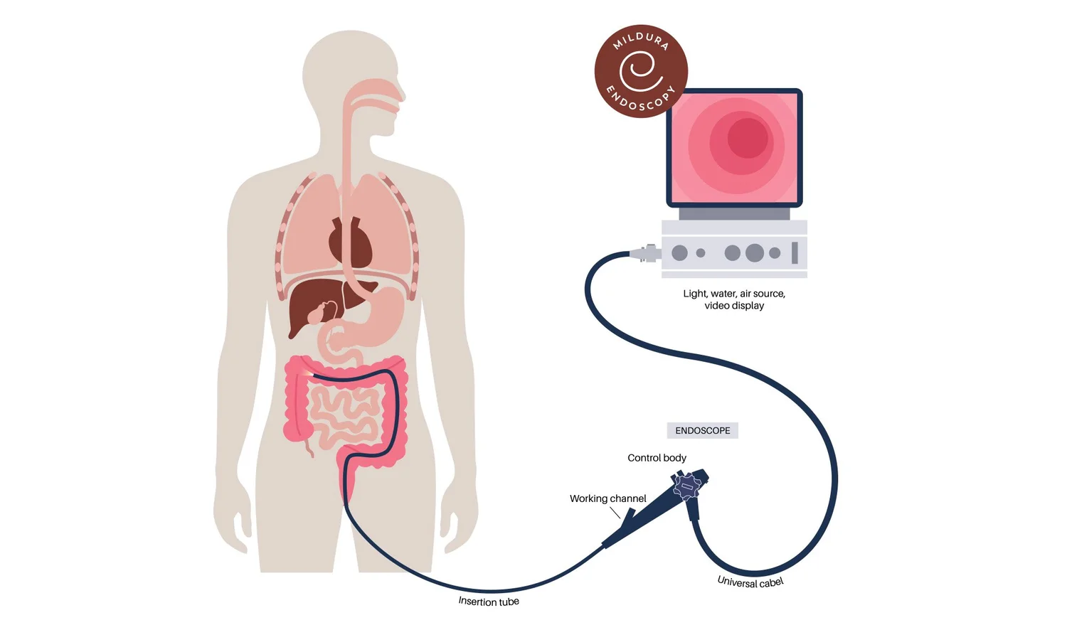 Mildura Endoscopy | Gastroscopy & Colonoscopy