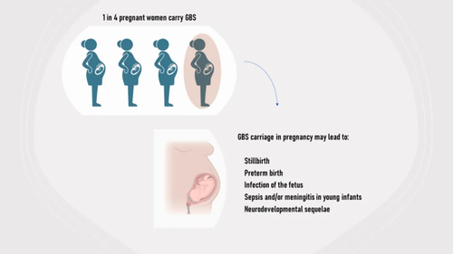 What pregnant women should know about Group B Streptococcus (GBS)? — ISSAD