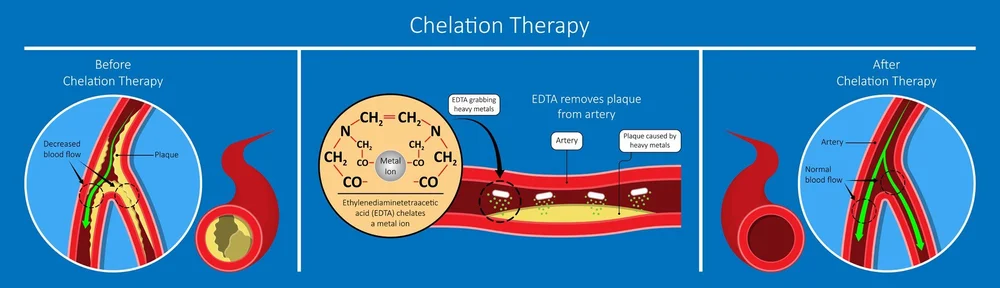 What is Chelation Therapy? — Colin Chan, MD & Associates