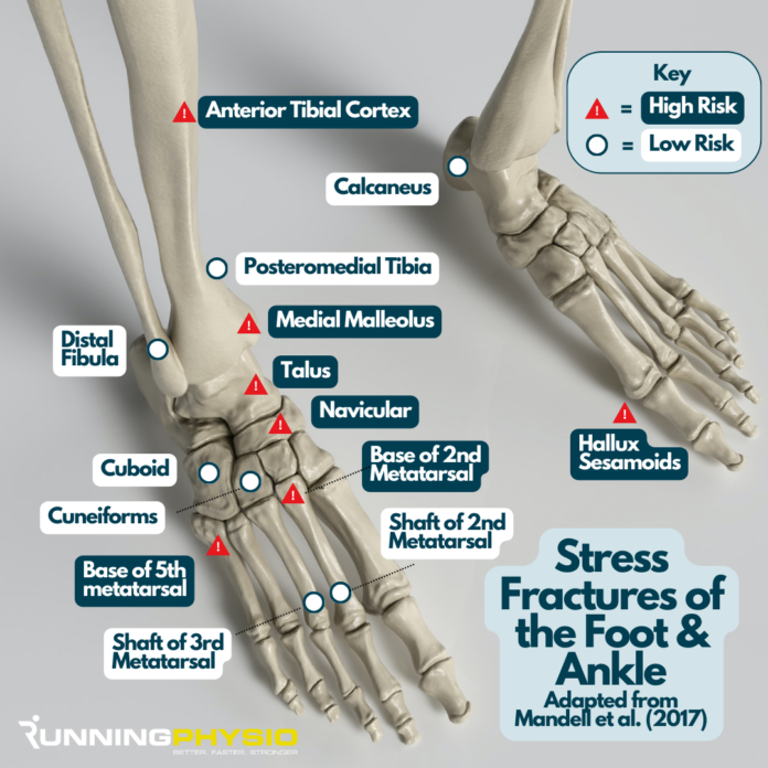 Bone Stress Injury / Fracture : A Comprehensive Rehab Guide! — buanphysio
