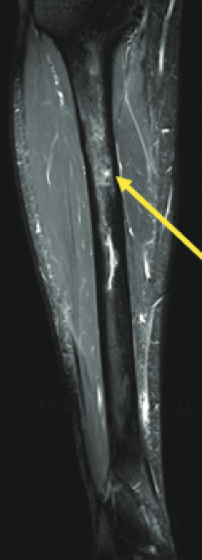 Bone Stress Injury / Fracture : A Comprehensive Rehab Guide! — buanphysio