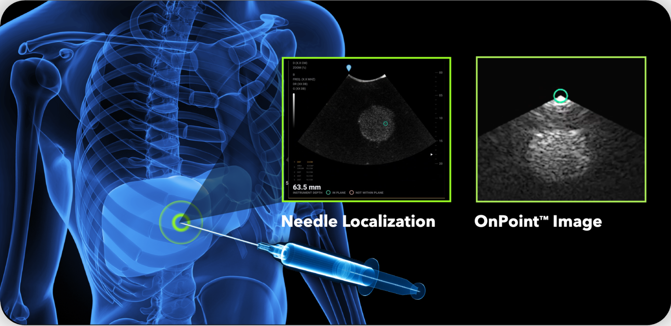 NeedleVue™ Technology — DeepSight Technology