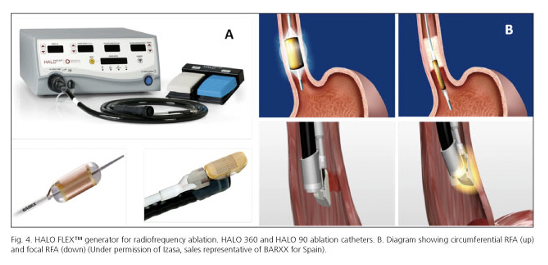 Barrett’s oesophagus endoscopic therapy — Leonda Gastroenterology