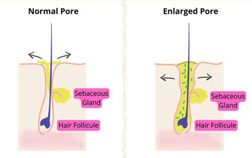 How to Minimize Large Pores with Korean Skincare — Helping You Feel ...