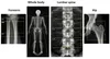 DEXA Scan Explained: Bone Density, FRAX & Risk | London | Dr Animesh ...