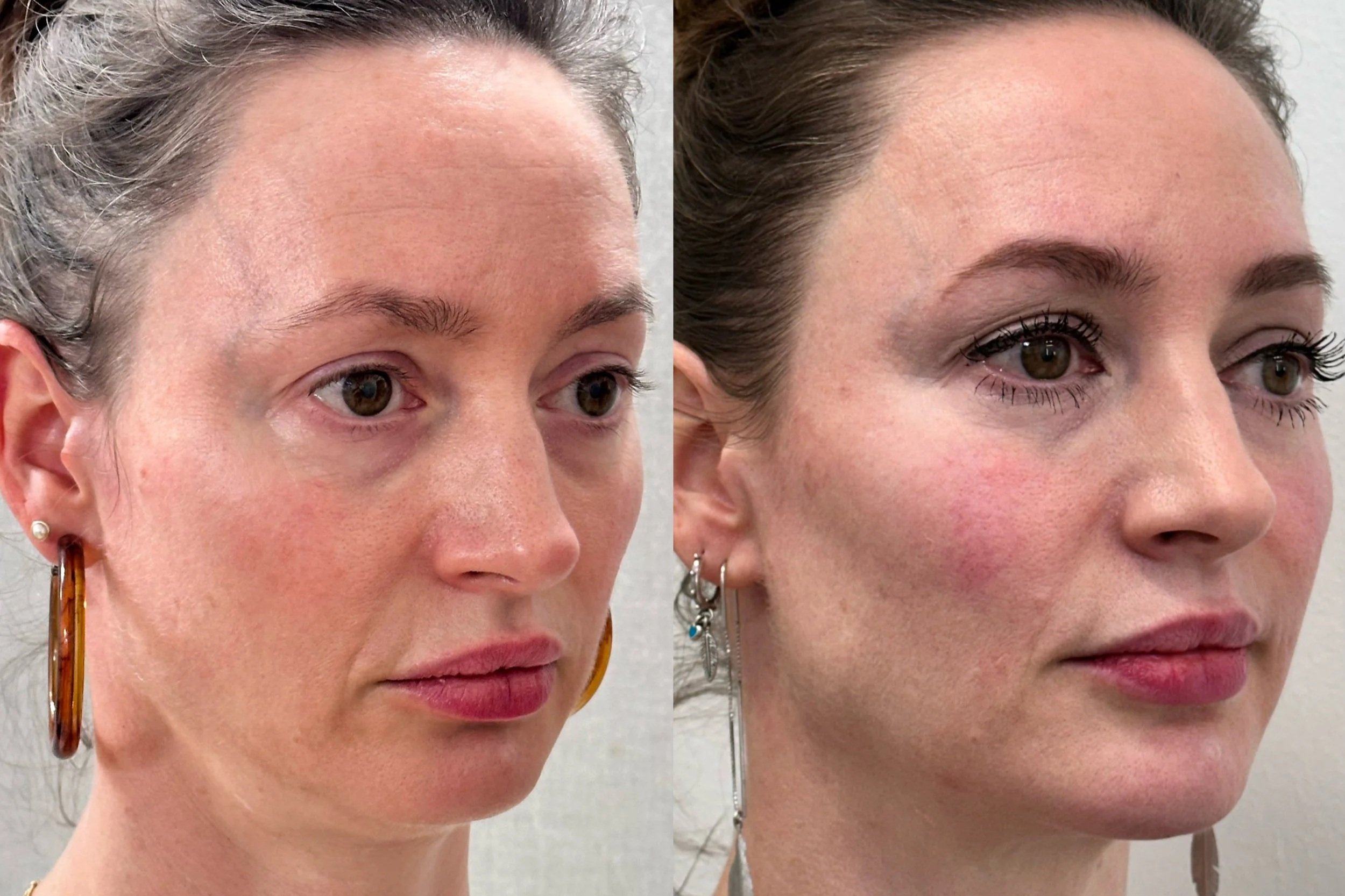 Endolift London | Non-Surgical Skin Tightening — Dr Hanson Clinic