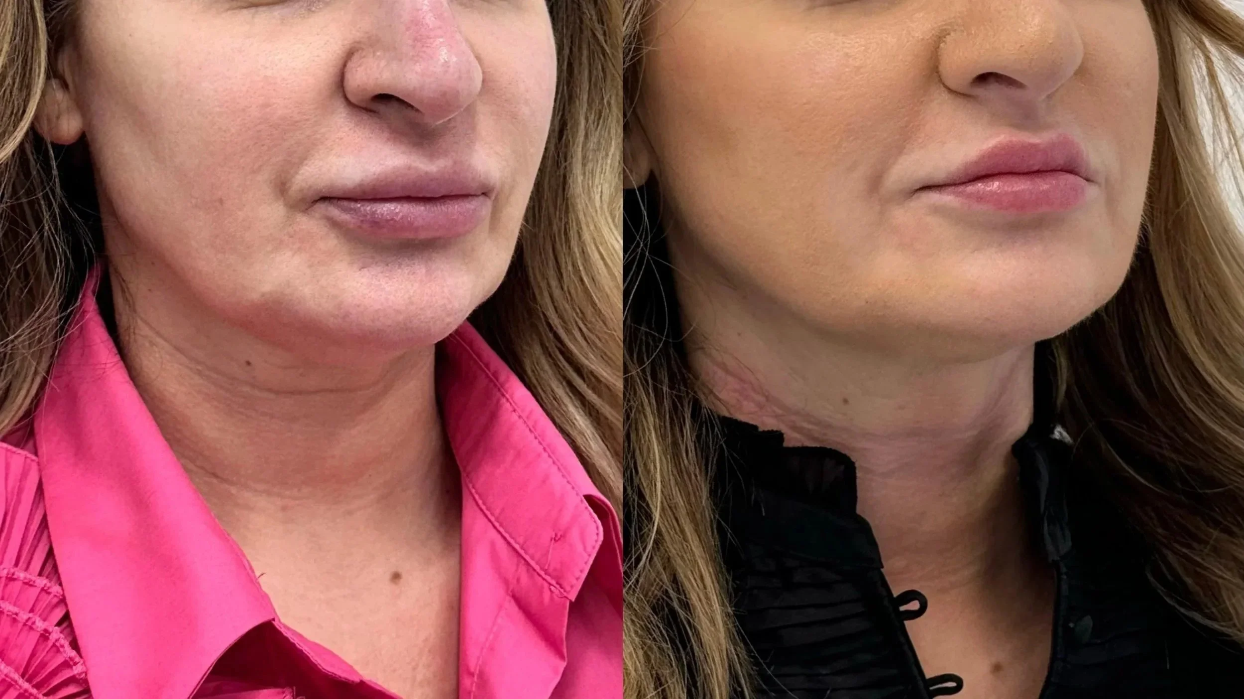 Endolift London | Non-Surgical Skin Tightening — Dr Hanson Clinic