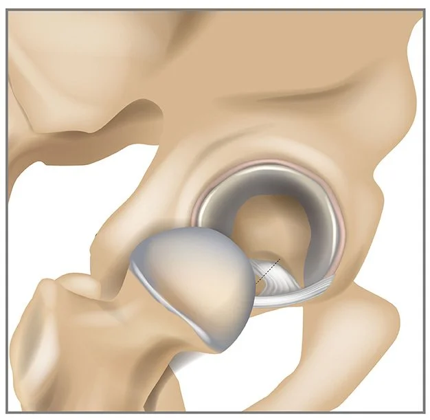 Hip Labral Repair and Reconstruction — Mr Ian Al'Khafaji | Melbourne ...
