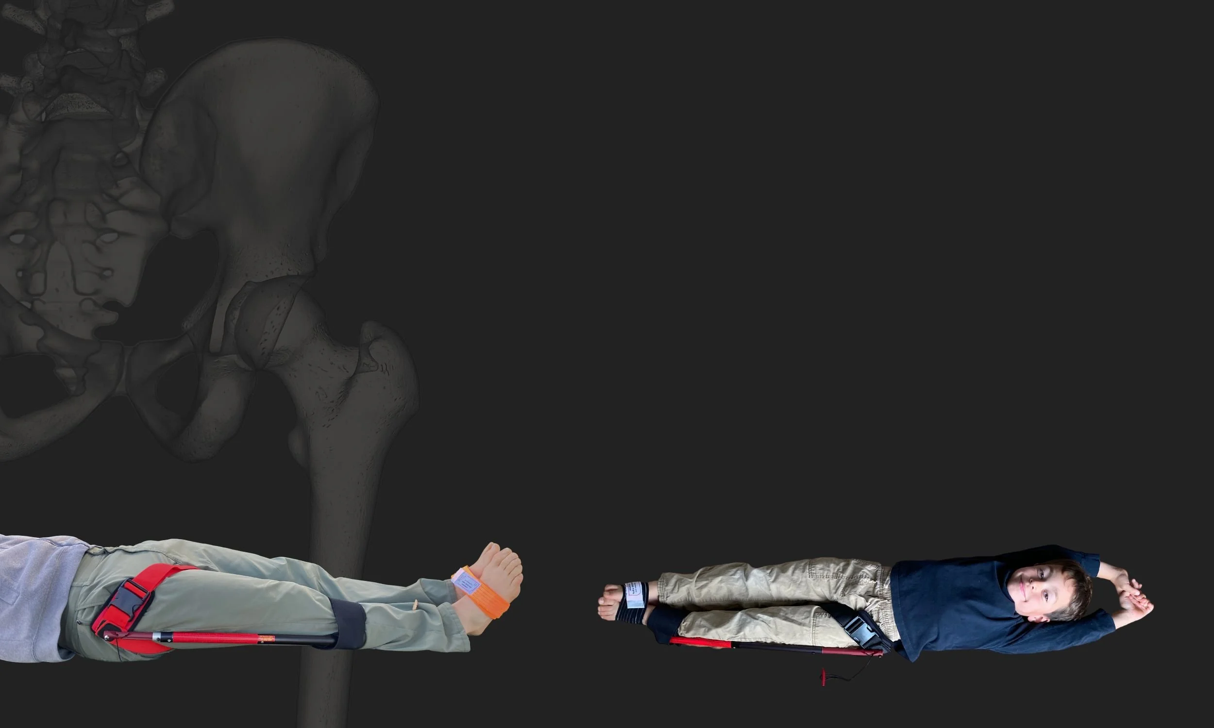 Slishman Traction Splint — Slishman Solutions