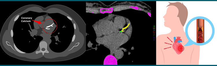 CT Calcium Score | Evaluate Heart Health Today — Reform Radiology
