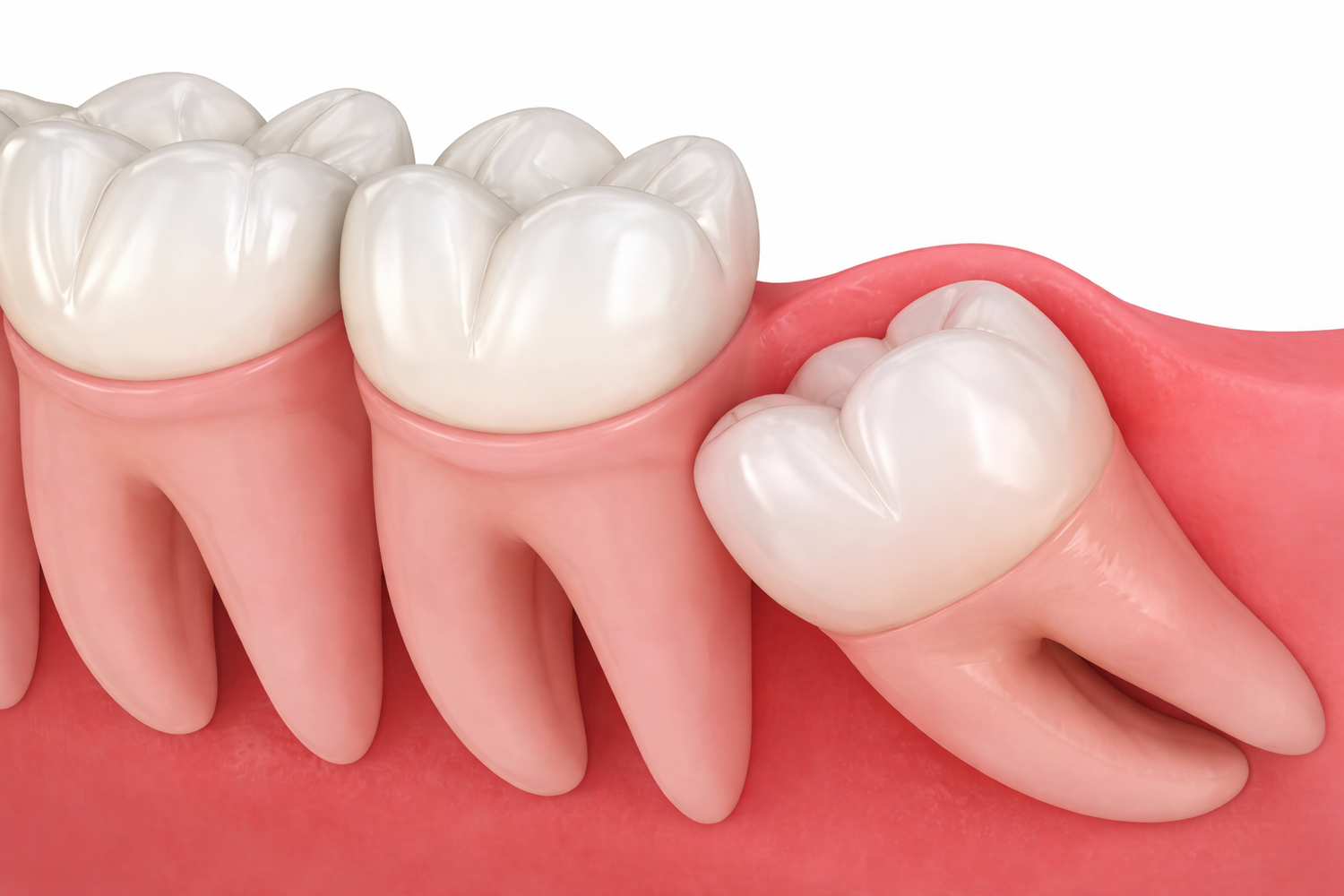 Wisdom Teeth Trouble? 9 Signs You Might Need an Extraction (and When ...