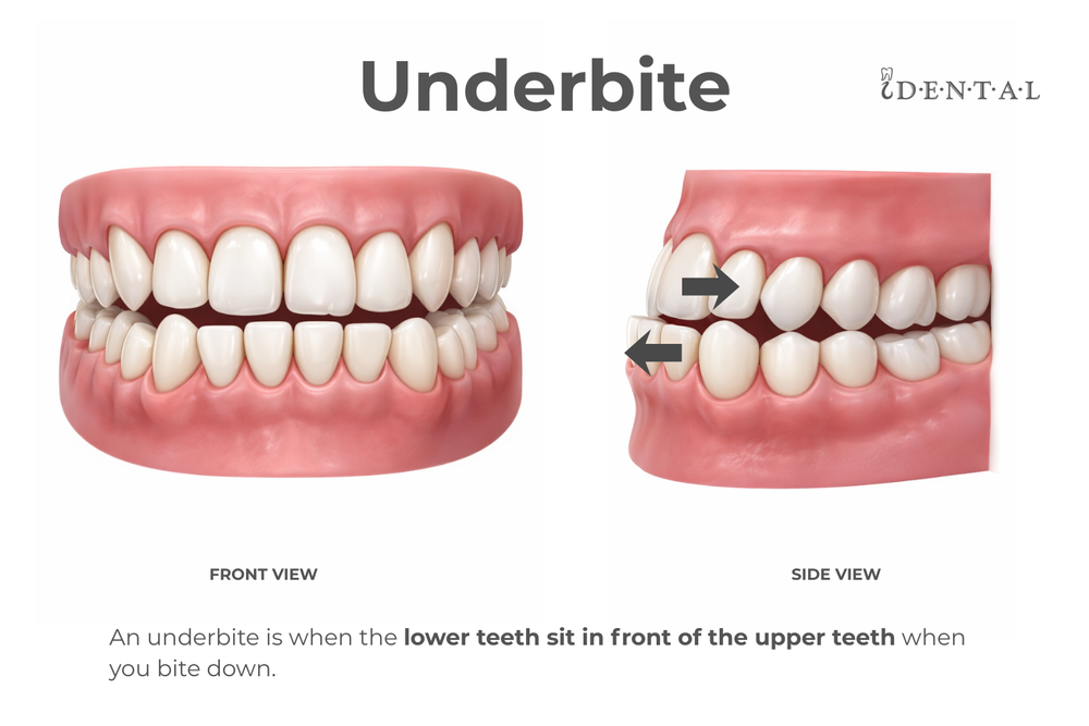 Overbite vs. Underbite: What They Mean and Why It Matters — iDental ...
